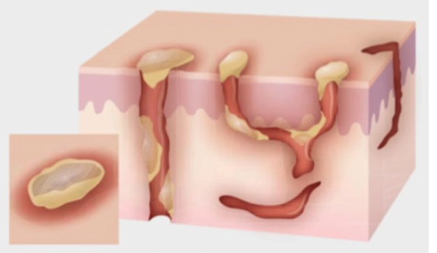 Sintomi idrosadenite suppurativa o acne inversa | La pelle conta
